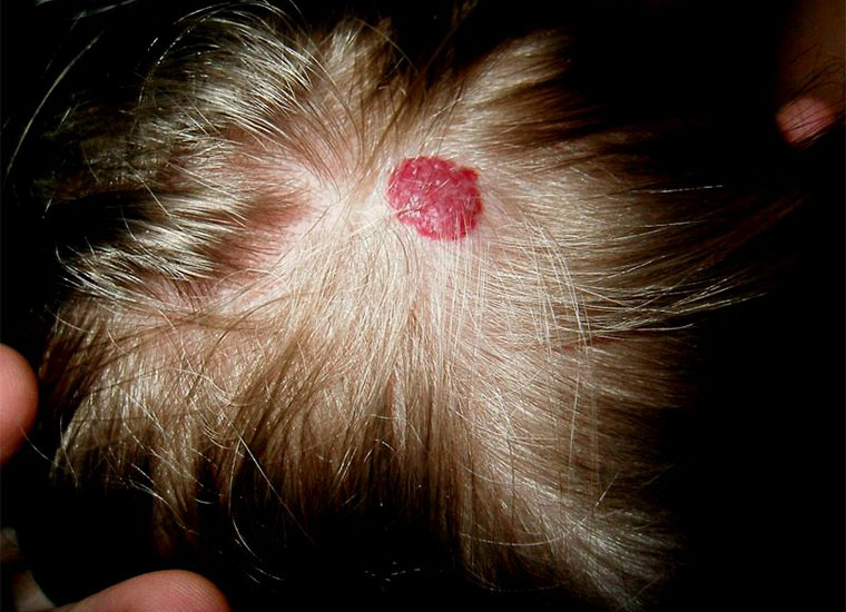 Angioma: cos'è, sintomi e cause
